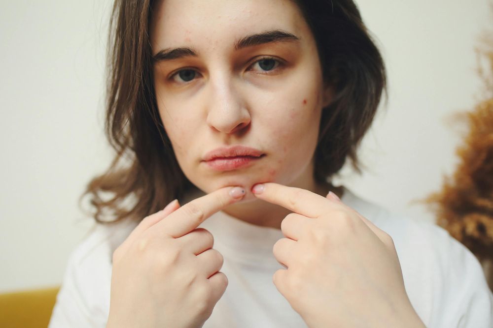 DIY Pimple Patches and Homemade Acne Remedies That Actually Work ...